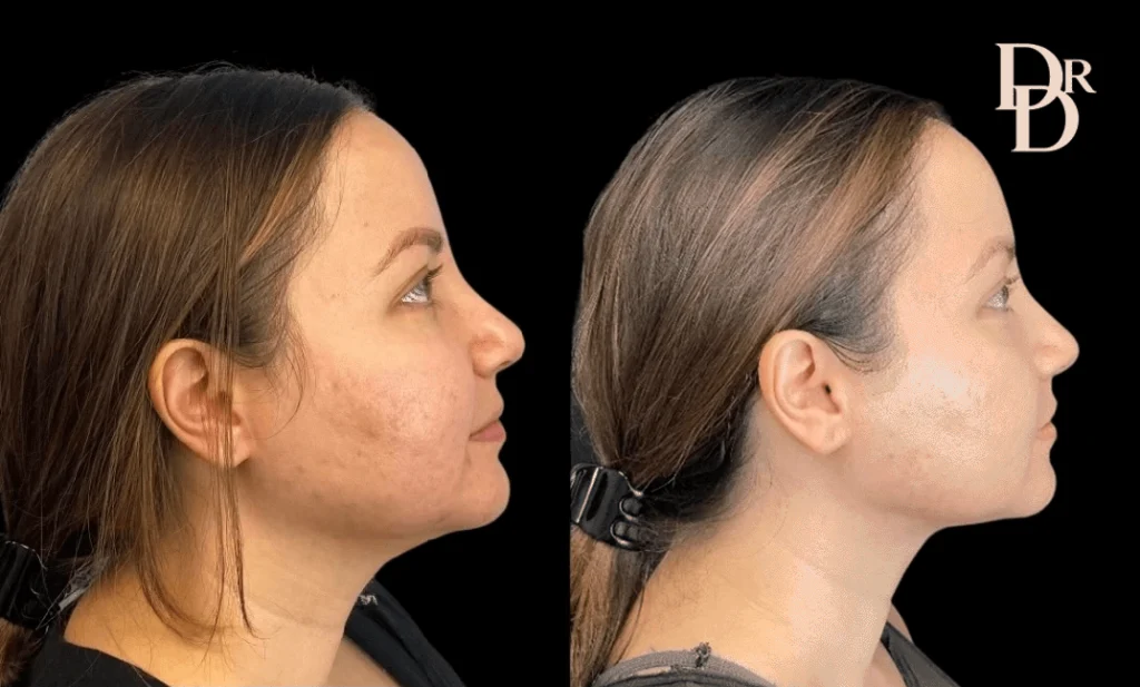 FaceTite Before & After Gallery in Tampa | Dr. Demetri MD