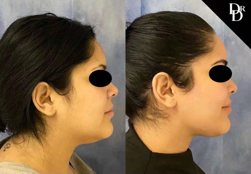 Neck Liposuction Before & After Photos | Dr. Demetri MD