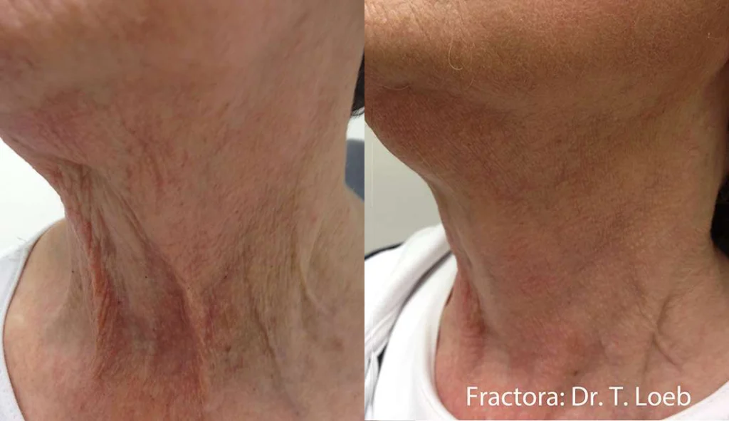 FaceTite Before & After Gallery in Tampa | Dr. Demetri MD